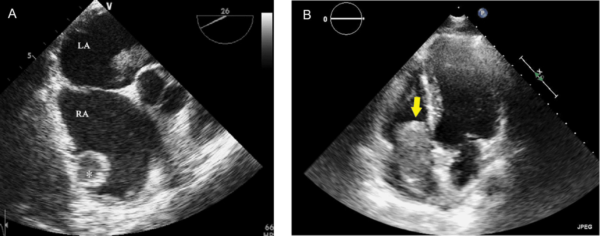Trombo em Trânsito: Papel da Ecocardiografia - Blog Ecope