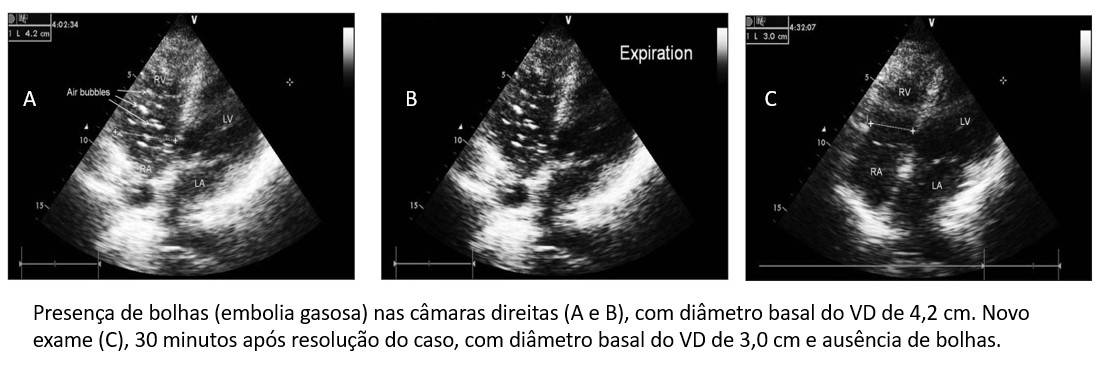 Embolia Gasosa: o ecocardiograma pode ajudar - Blog Ecope