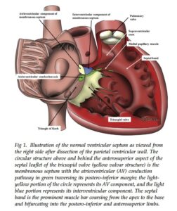Comunicação Interventricular: classificação pela 11ª Iteration of the ...