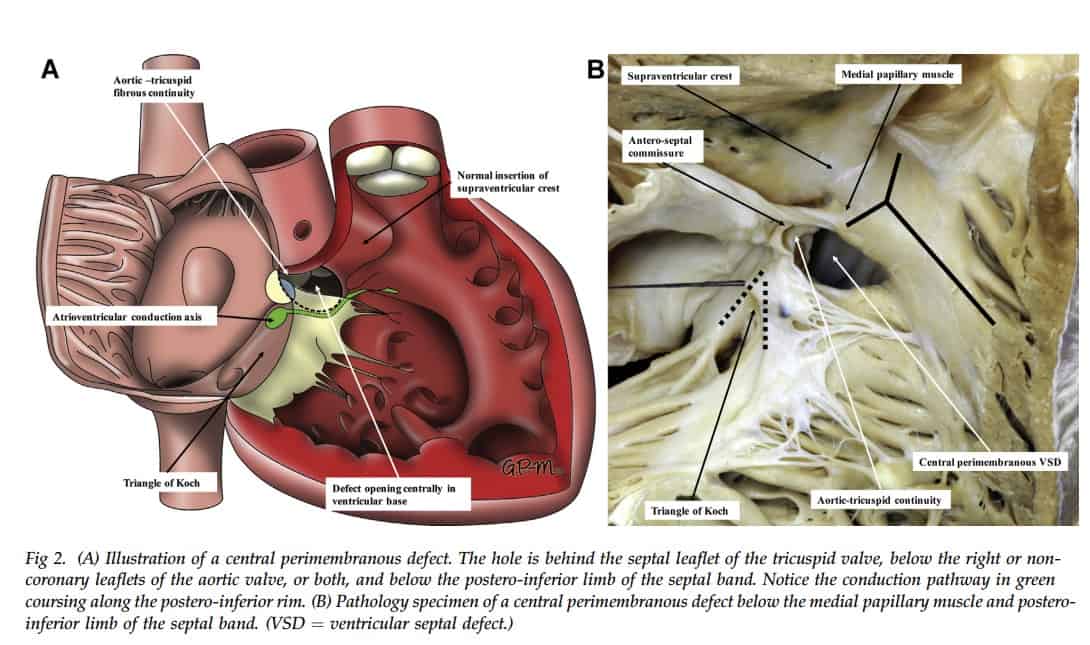 Comunicação Interventricular: classificação pela 11ª Iteration of the ...