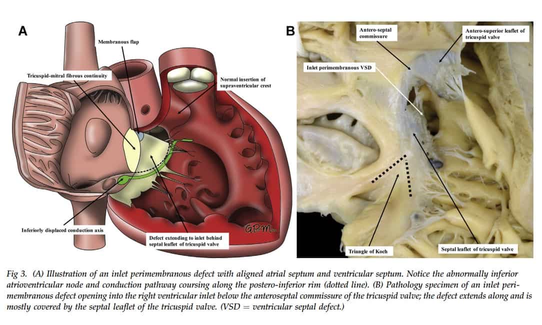 Comunicação Interventricular: classificação pela 11ª Iteration of the ...