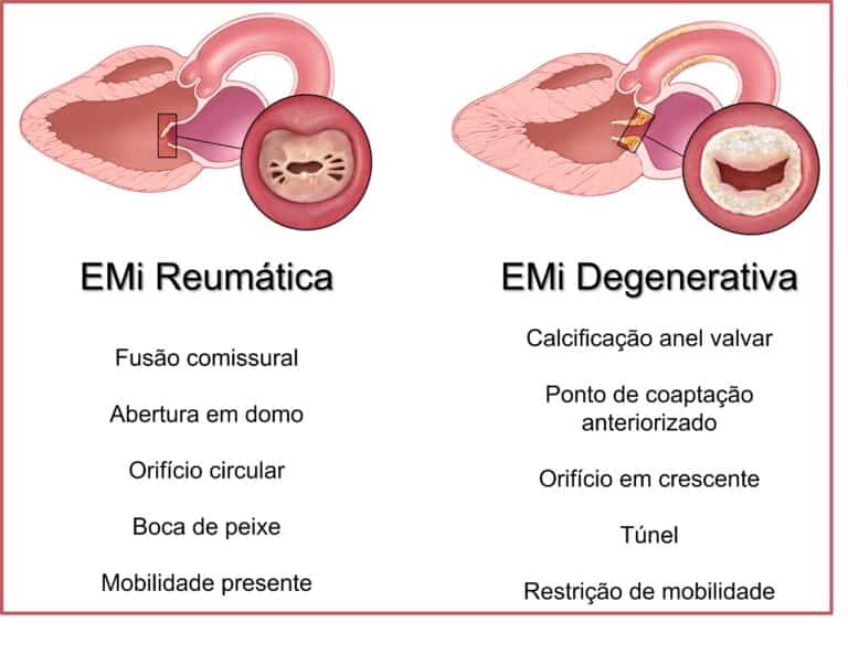 Estenose Mitral Degenerativa x Reumática: aspectos ecocardiográficos ...