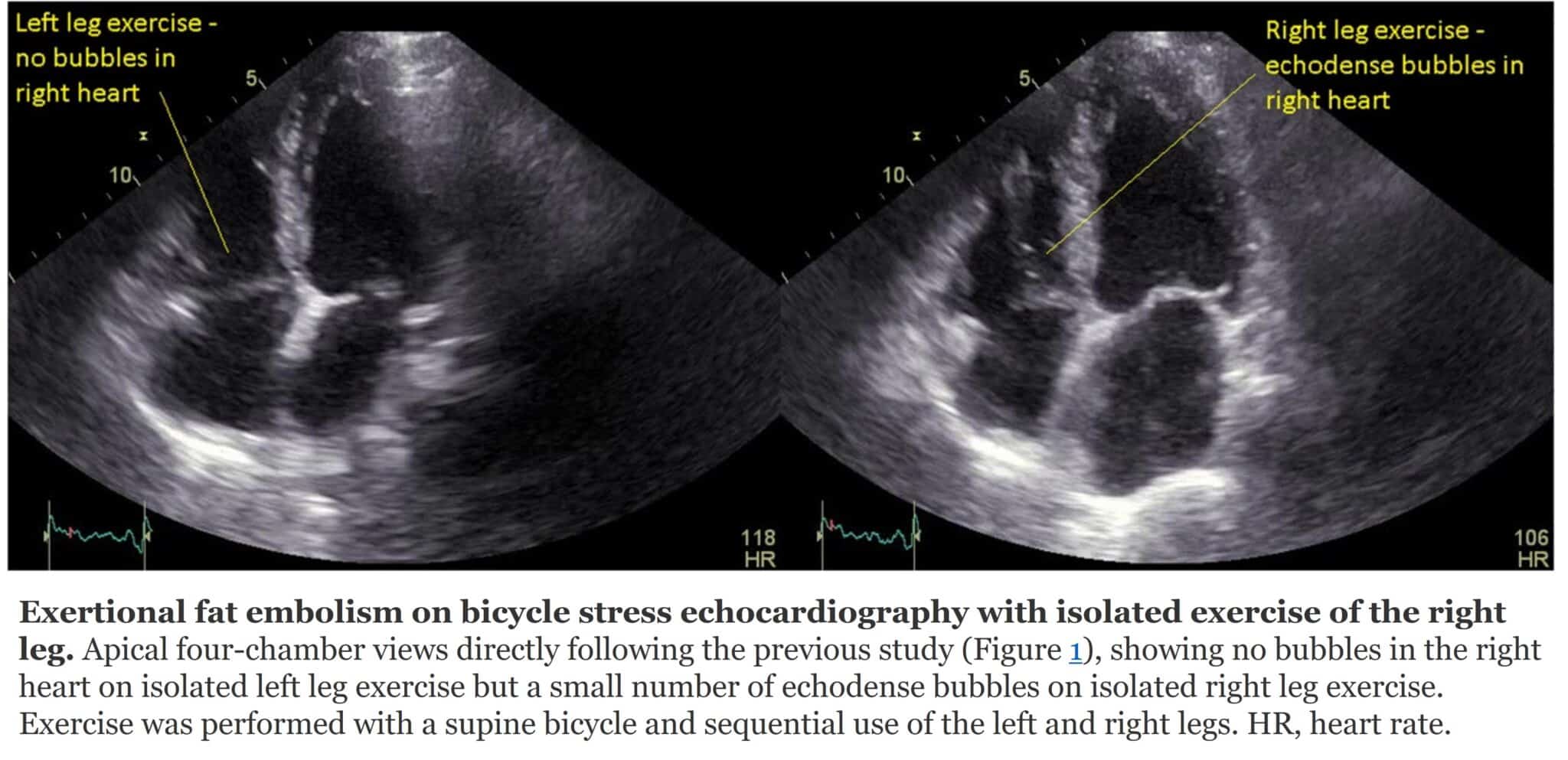 Embolia Gordurosa: como o ecocardiograma pode ajudar - Blog Ecope