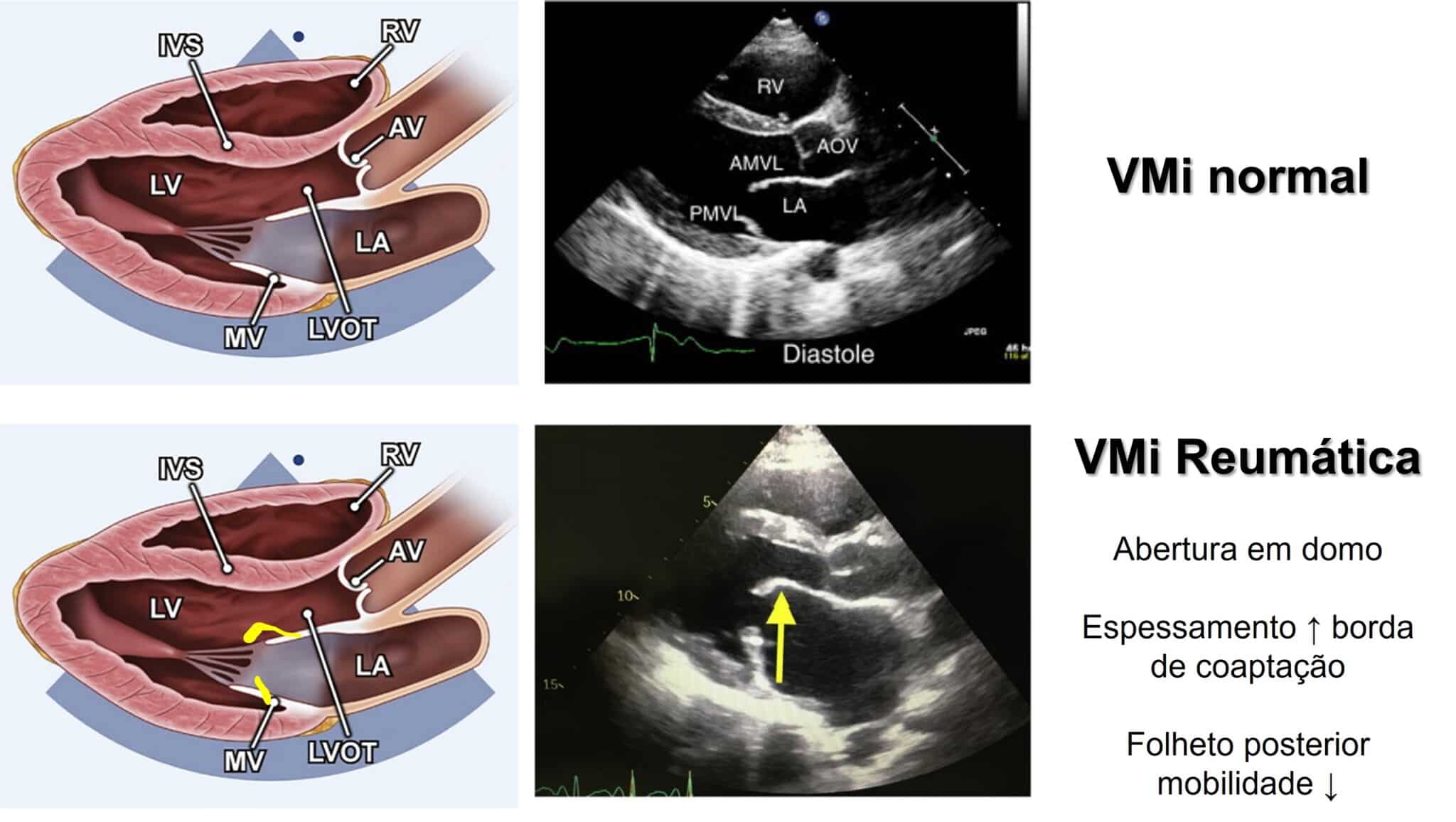 Estenose Da Valva Atrioventricular Esquerda Mitral - RETOEDU