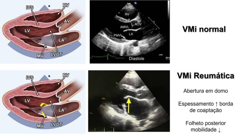 Estenose Mitral Degenerativa x Reumática: aspectos ecocardiográficos ...