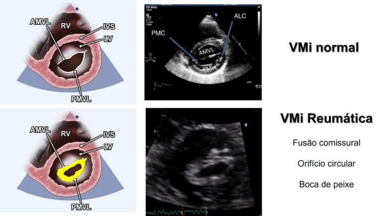 Estenose Mitral Degenerativa x Reumática: aspectos ecocardiográficos ...