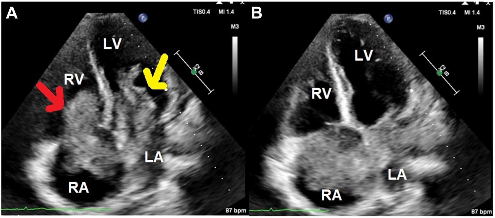 Mixoma Biatrial: apresentação rara - Blog Ecope