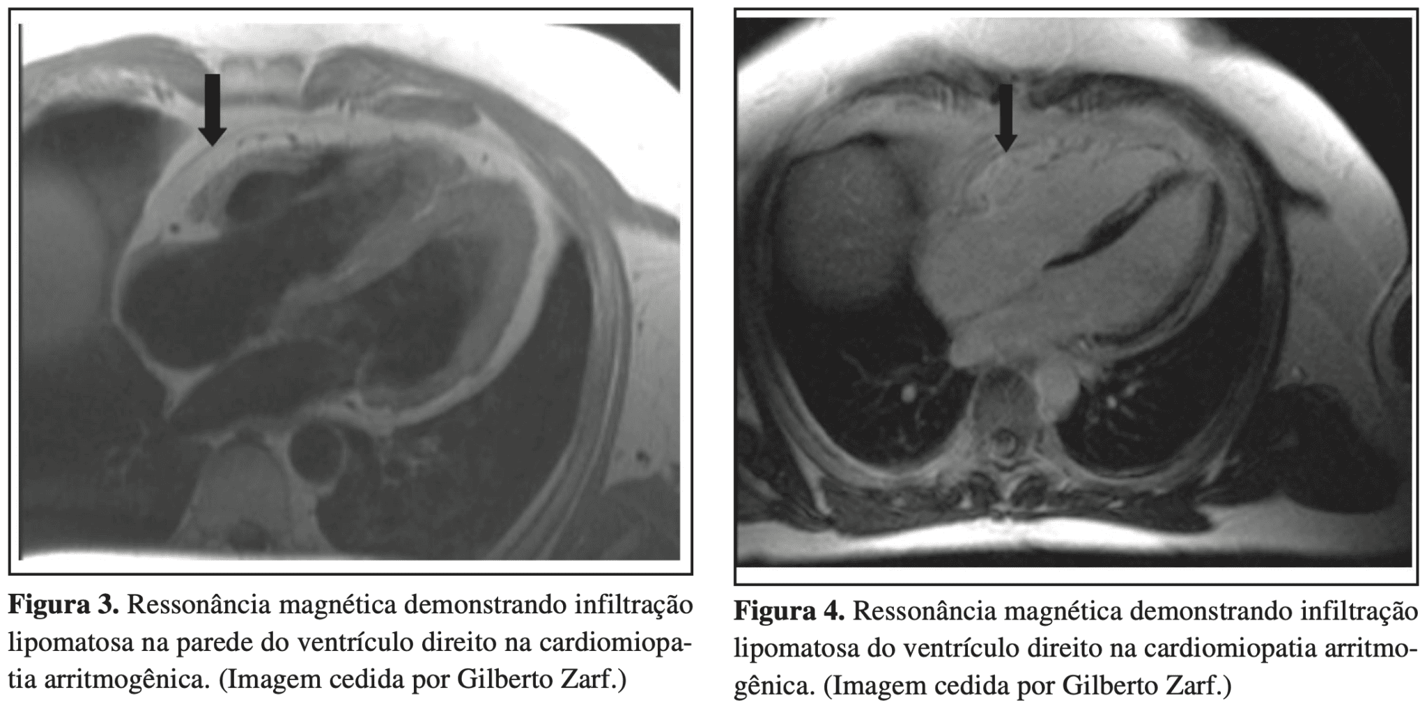 Cardiomiopatia Arritmogênica do Ventrículo Direito: revisão - Blog Ecope