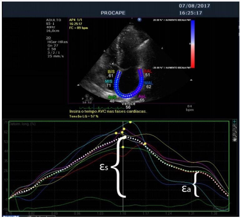 Strain do Átrio Esquerdo: conceitos básicos - Blog Ecope