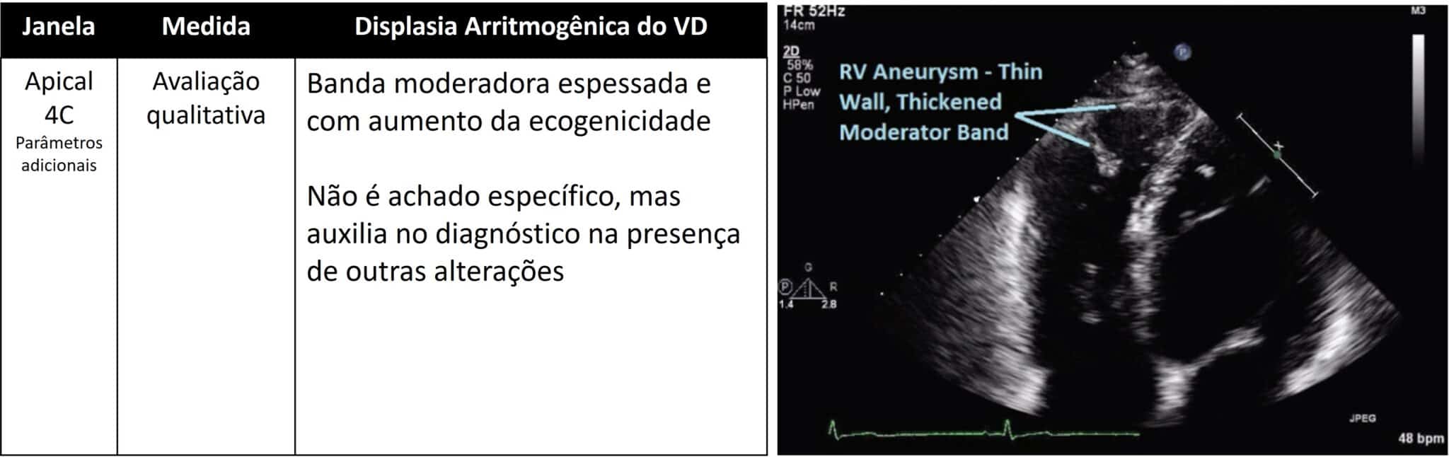 Cardiomiopatia Arritmogênica do Ventrículo Direito: critérios ecocardiográficos - Blog Ecope