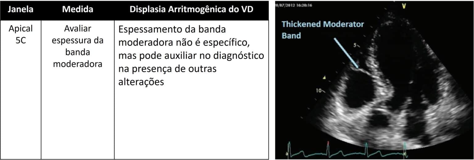 Cardiomiopatia Arritmogênica do Ventrículo Direito: critérios ecocardiográficos - Blog Ecope