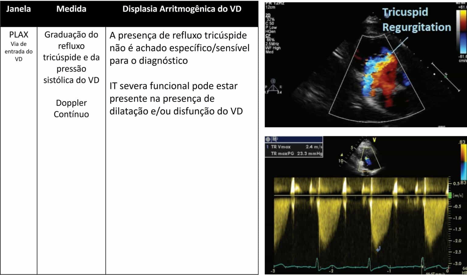 Cardiomiopatia Arritmogênica do Ventrículo Direito: critérios ...