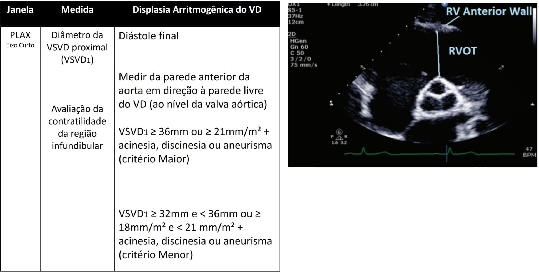 Cardiomiopatia Arritmogênica do Ventrículo Direito: critérios ecocardiográficos - Blog Ecope