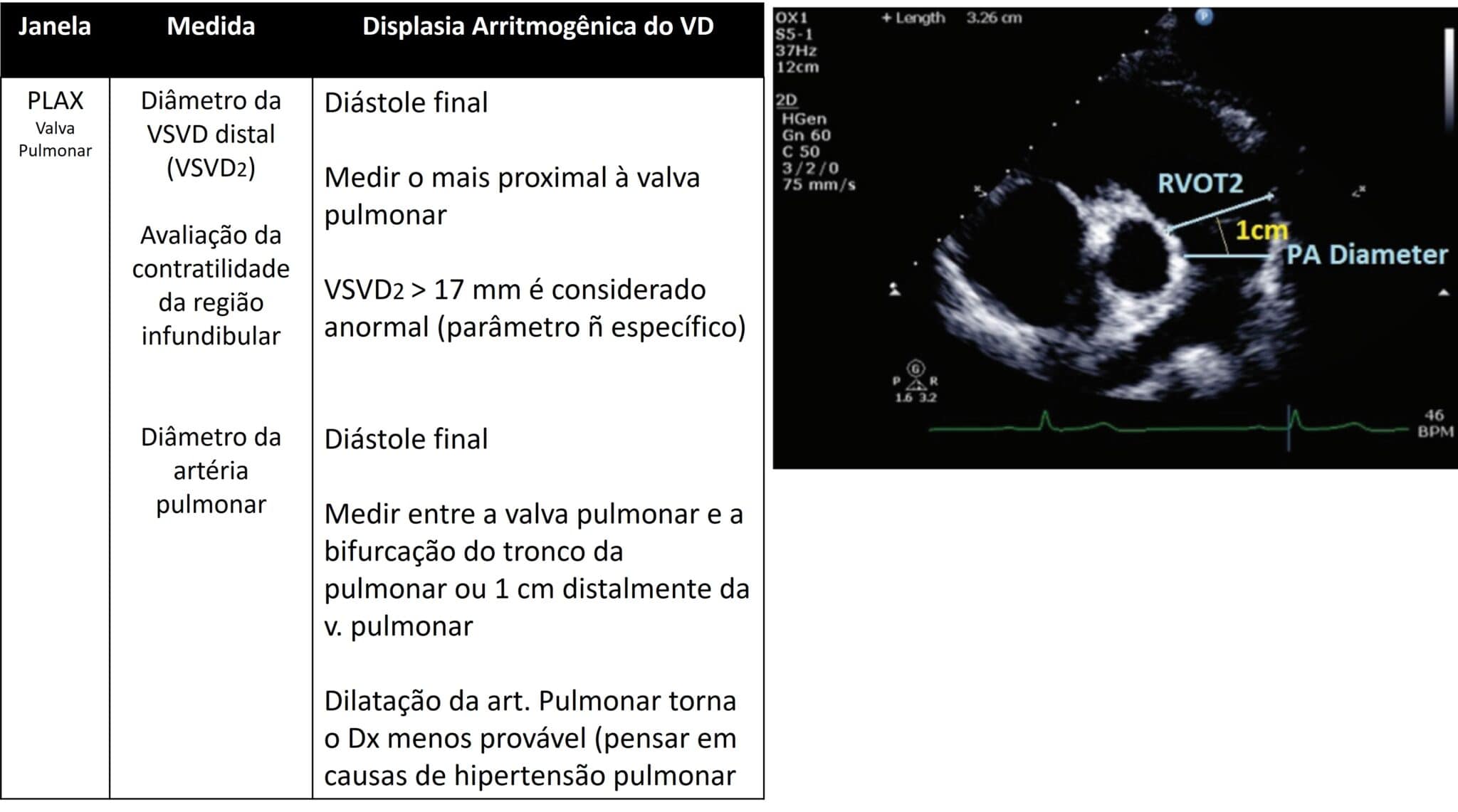 Cardiomiopatia Arritmogênica do Ventrículo Direito: critérios ecocardiográficos - Blog Ecope