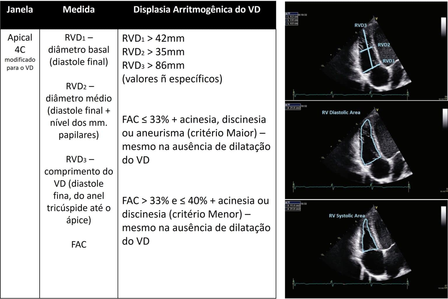 Cardiomiopatia Arritmogênica do Ventrículo Direito: critérios ecocardiográficos - Blog Ecope