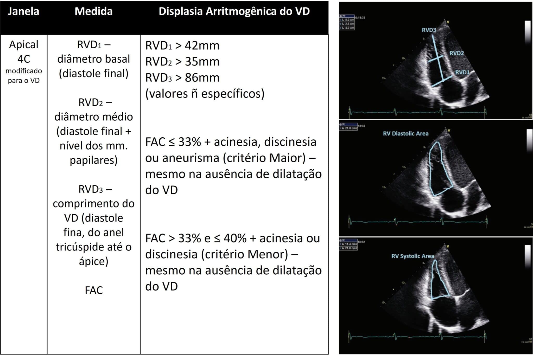 Cardiomiopatia Arritmogênica do Ventrículo Direito: critérios ...