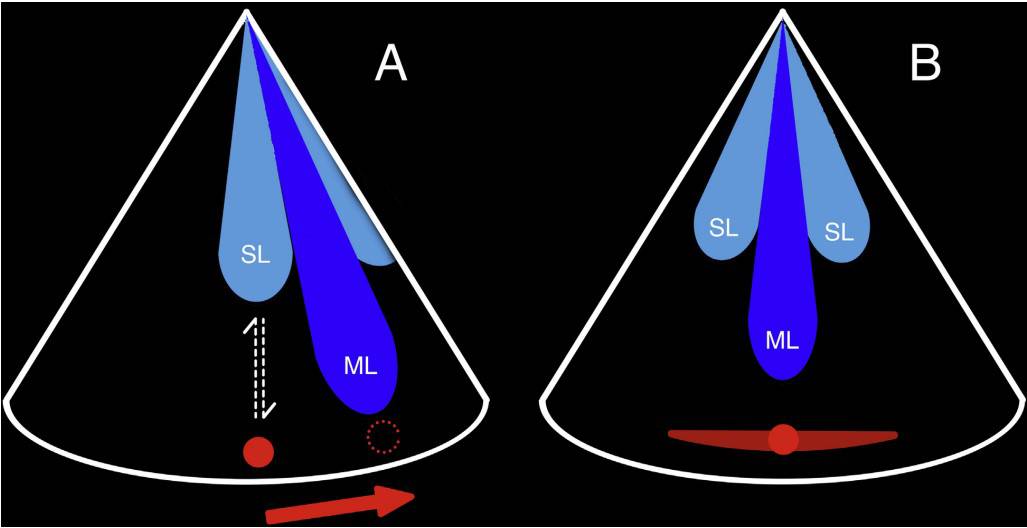 Splay Color: um marcador de gravidade na regurgitação mitral? - Blog Ecope