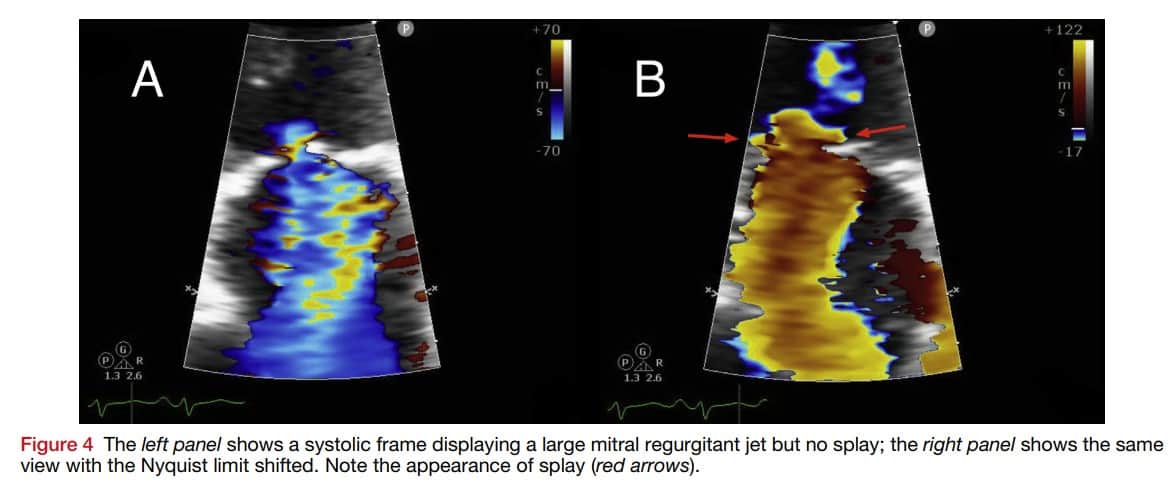 Splay Color: um marcador de gravidade na regurgitação mitral? - Blog Ecope