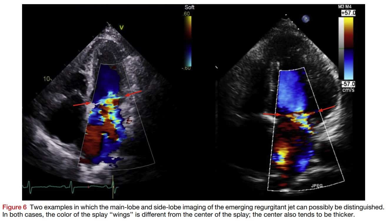 Splay Color: um marcador de gravidade na regurgitação mitral? - Blog Ecope