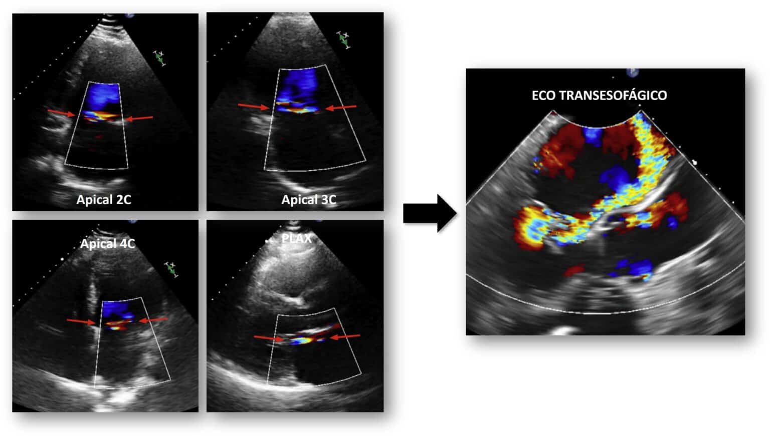 Splay Color: um marcador de gravidade na regurgitação mitral? - Blog Ecope