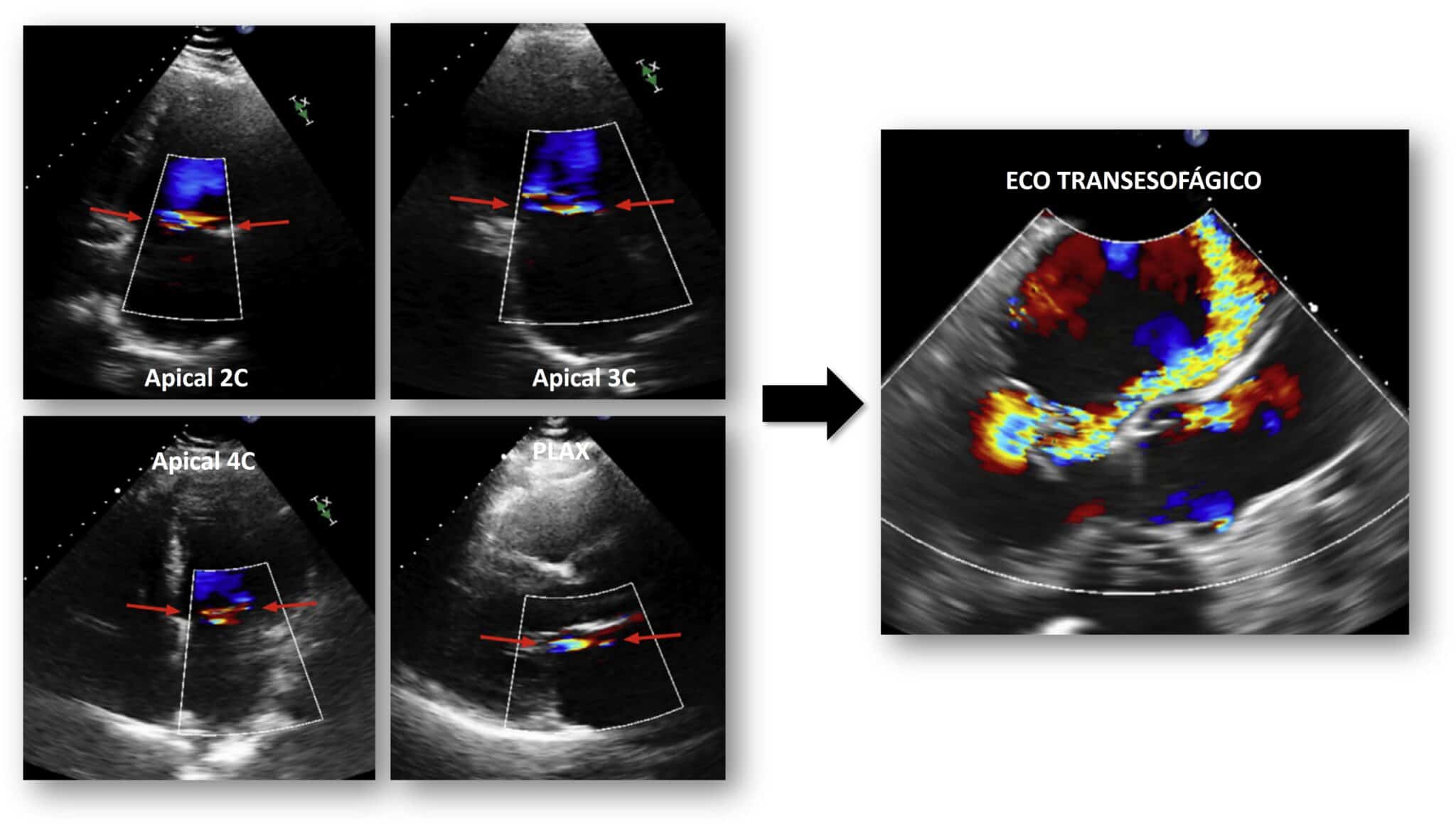 Splay Color: um marcador de gravidade na regurgitação mitral? - Blog Ecope
