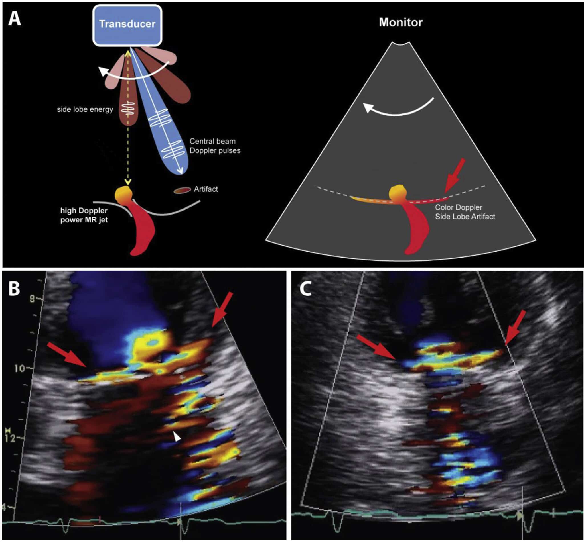 Splay Color: um marcador de gravidade na regurgitação mitral? - Blog Ecope