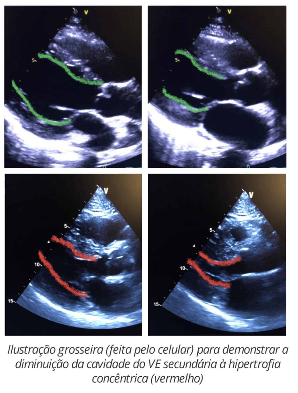 Avaliação Ecocardiográfica da Insuficiência Cardíaca: a hora e a vez ...