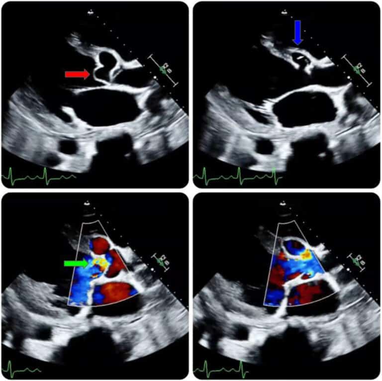 A Fisiologia da Diástole: compreendendo os padrões - Blog Ecope