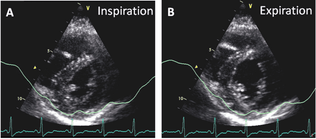 Pericardite Constritiva x Cardiomiopatia Restritiva: revisão de artigo ...