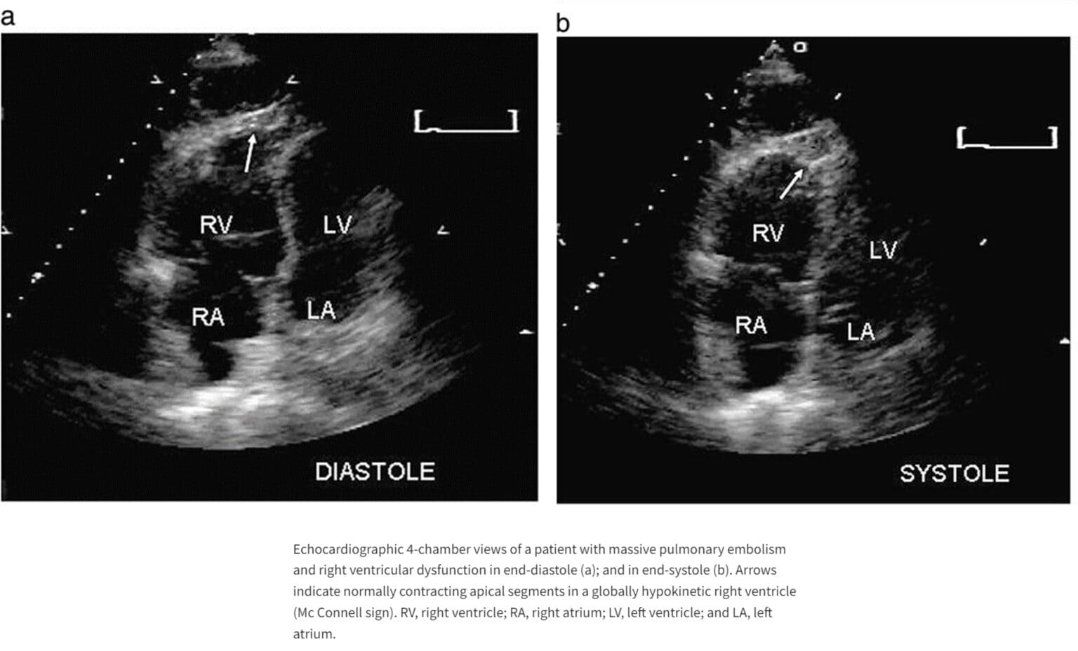60/60 Echo Sign: um marcador de embolia pulmonar - Blog Ecope