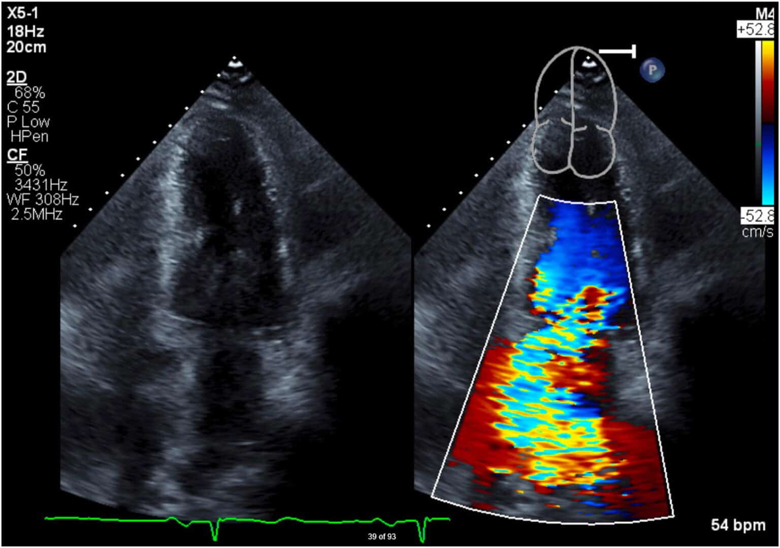 Insuficiência Mitral e Contraste Ecocardiográfico: relato de caso - Blog Ecope