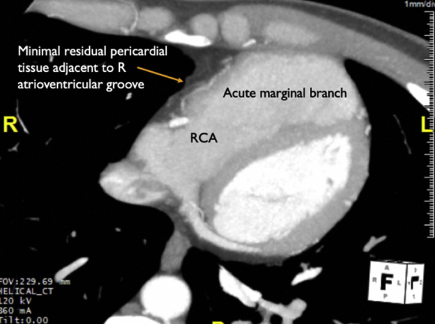Ausência Congênita de Pericárdio: caso clínico - Blog Ecope