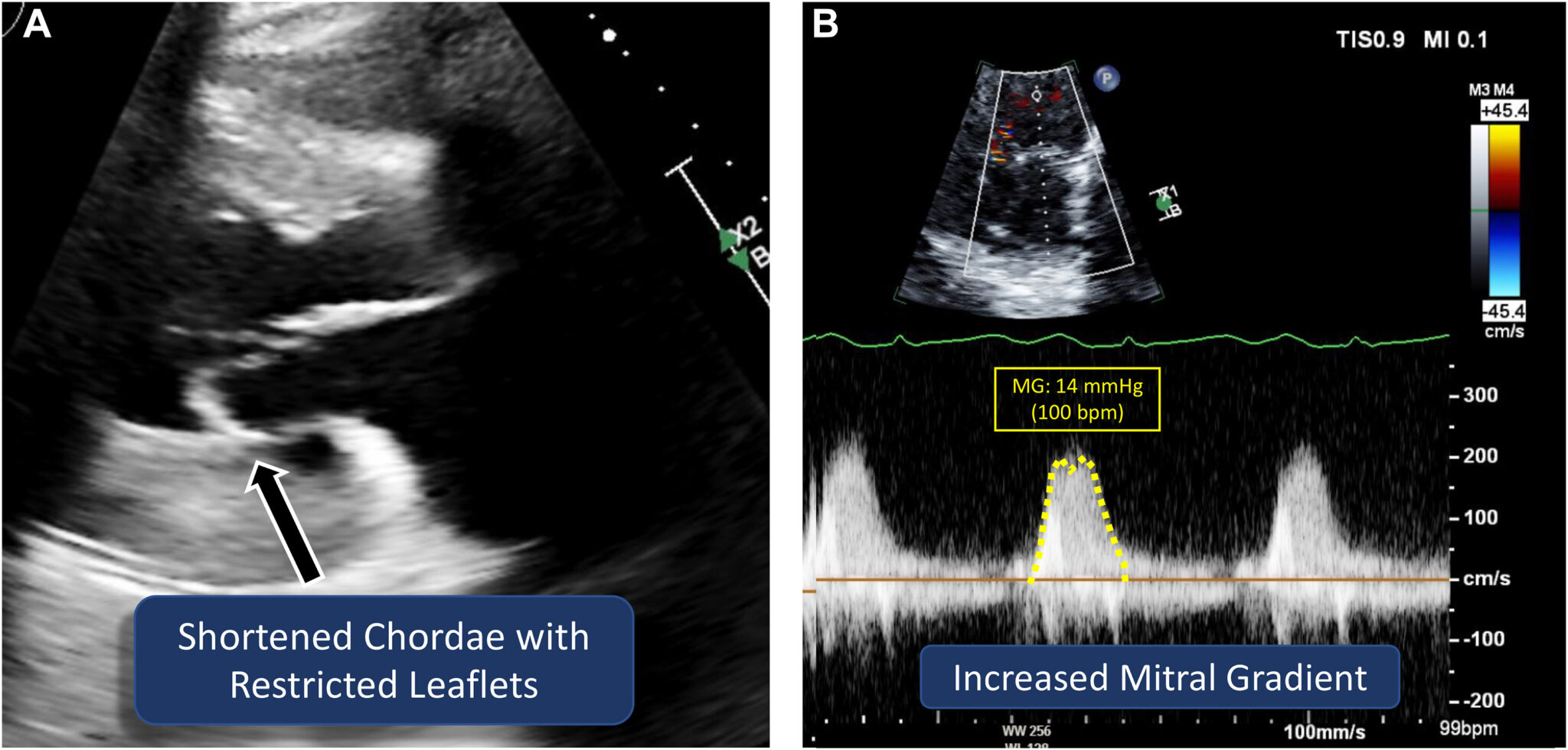 Complexo de Shone no Adulto: é raro, mas acontece - Blog Ecope