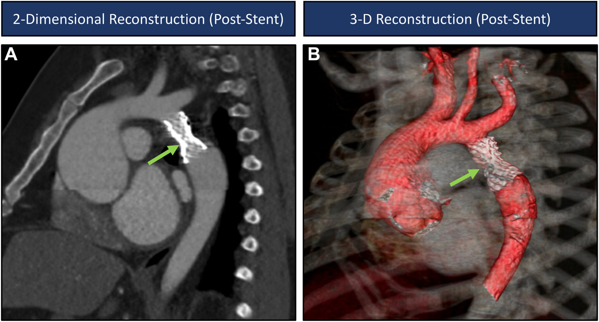 Complexo de Shone no Adulto: é raro, mas acontece - Blog Ecope