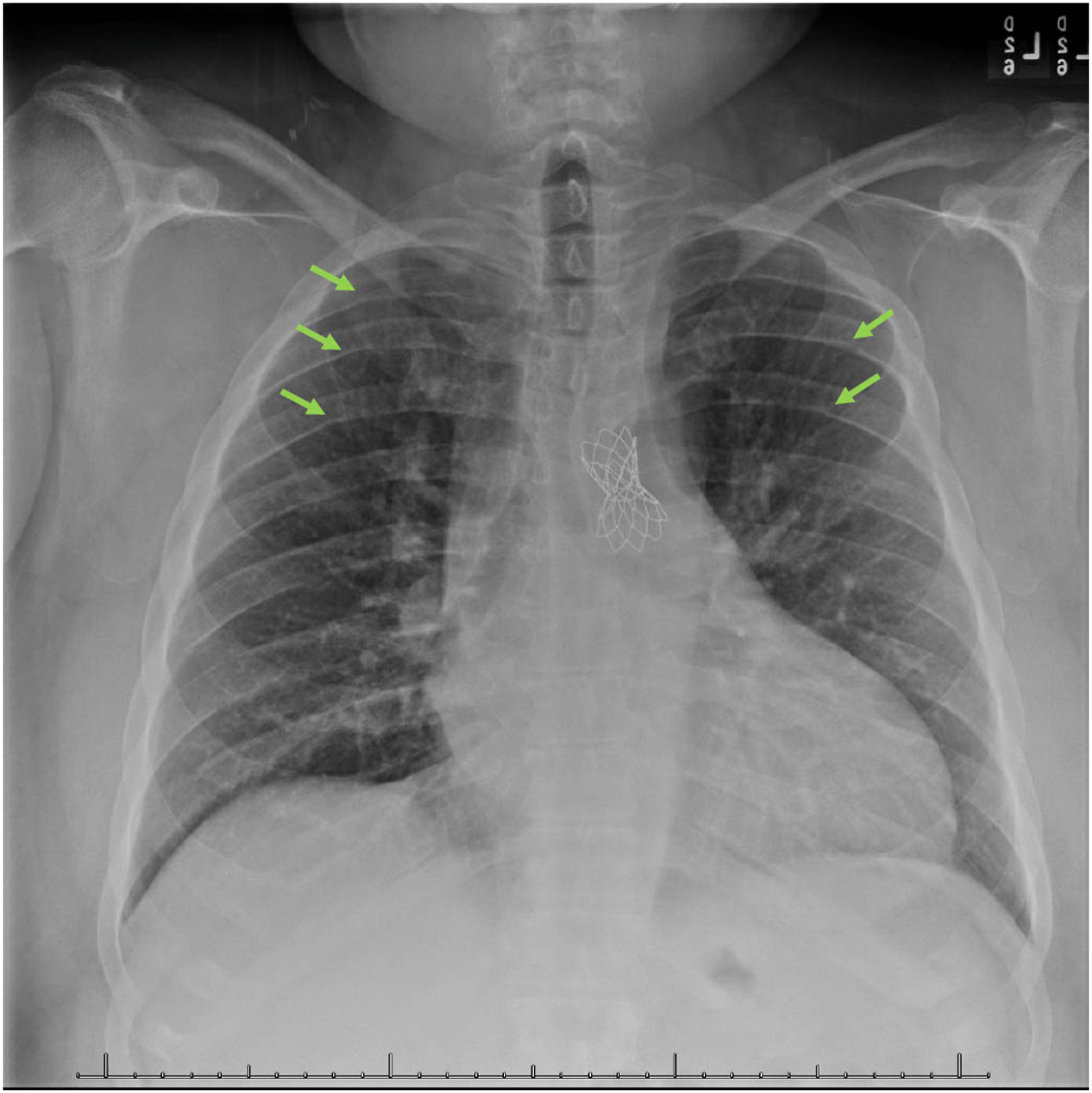 Complexo de Shone no Adulto: é raro, mas acontece - Blog Ecope
