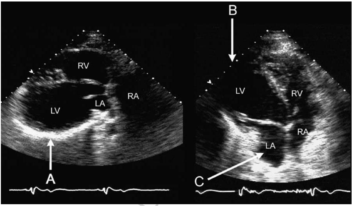 Ausência Congênita do Pericárdio: aspectos ecocardiográficos - Blog Ecope