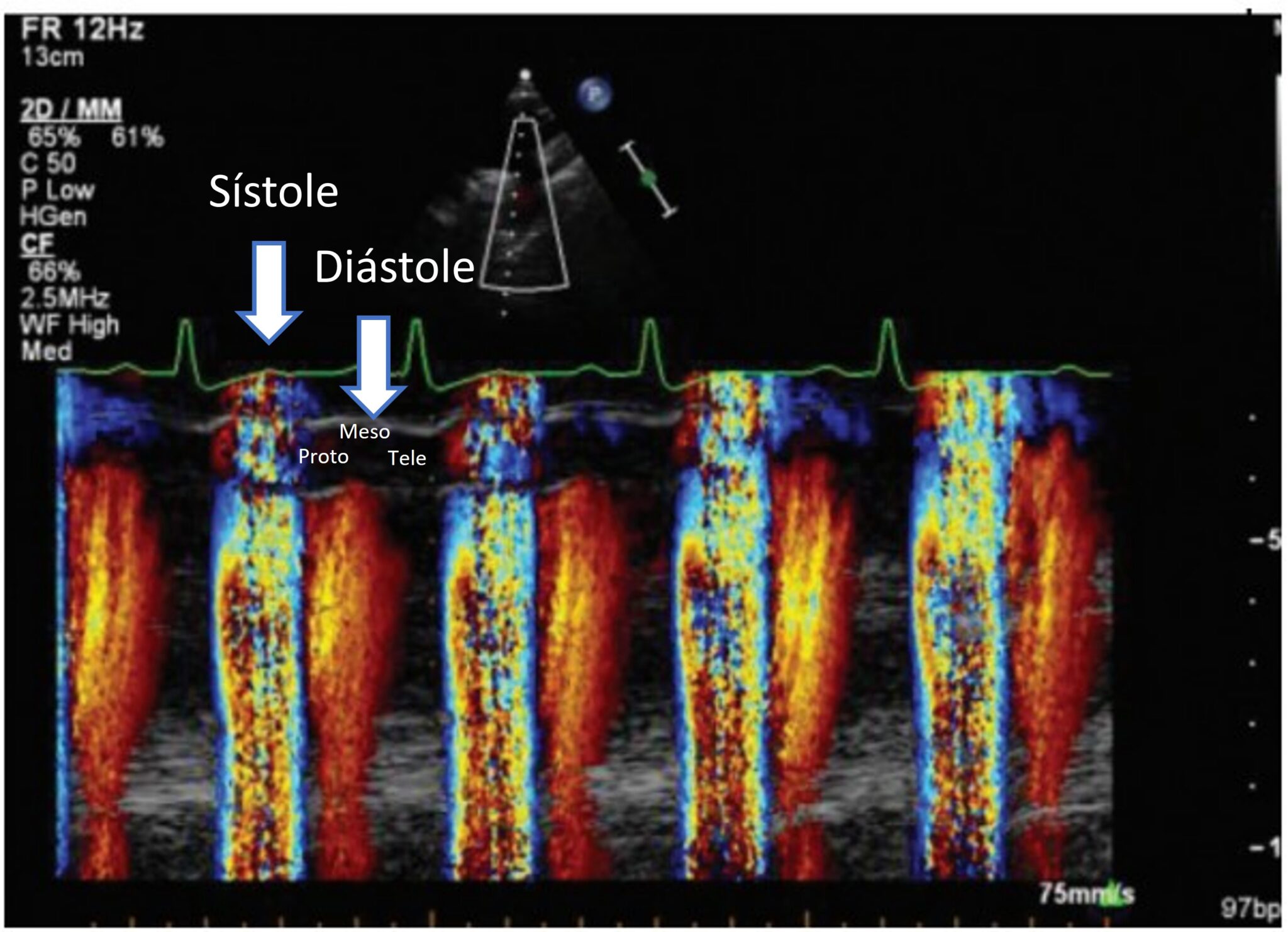 Fluxo Reverso Holodiastólico na Aorta Descendente: o modo M pode ajudar ...