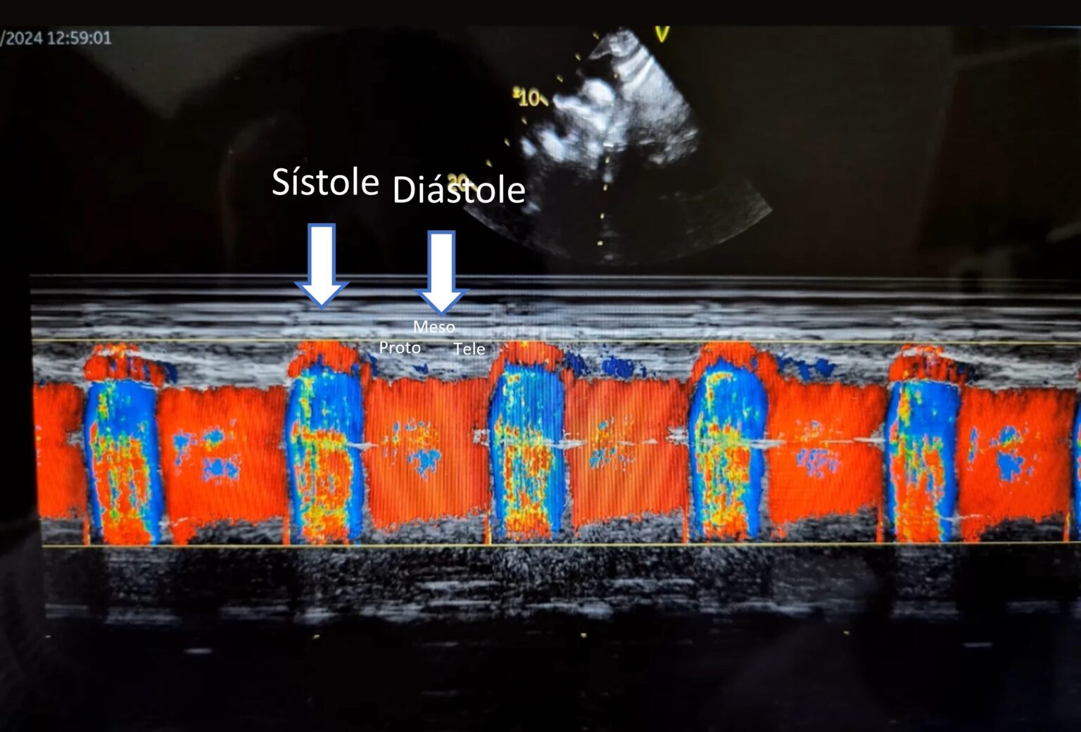 Fluxo Reverso Holodiastólico na Aorta Descendente: o modo M pode ajudar ...