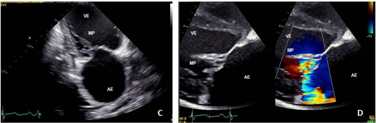 Valva Mitral em Arcada: aspectos ecocardiográficos - Blog Ecope
