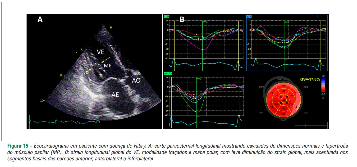 Strain nas Cardiopatias Raras: revisão de artigo (parte IV – Amiloidose, Hemocromatose, Danon e ...