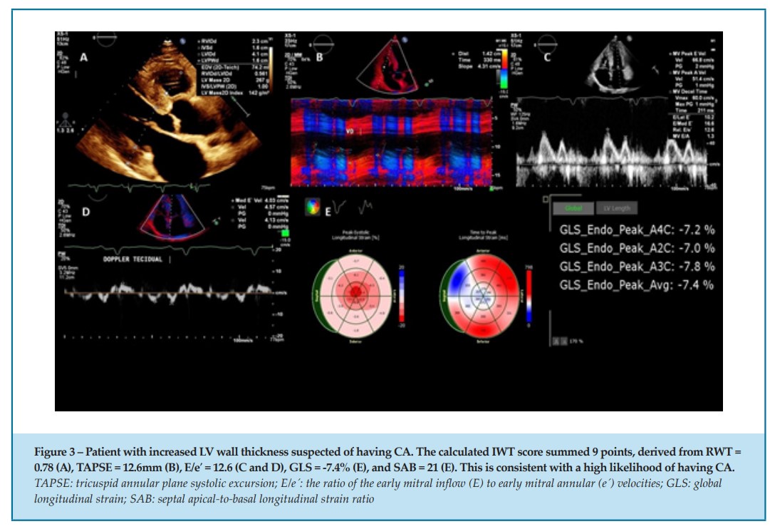 Achados Ecocardiográficos na Amiloidose Cardíaca: agora por brasileiros - Blog Ecope