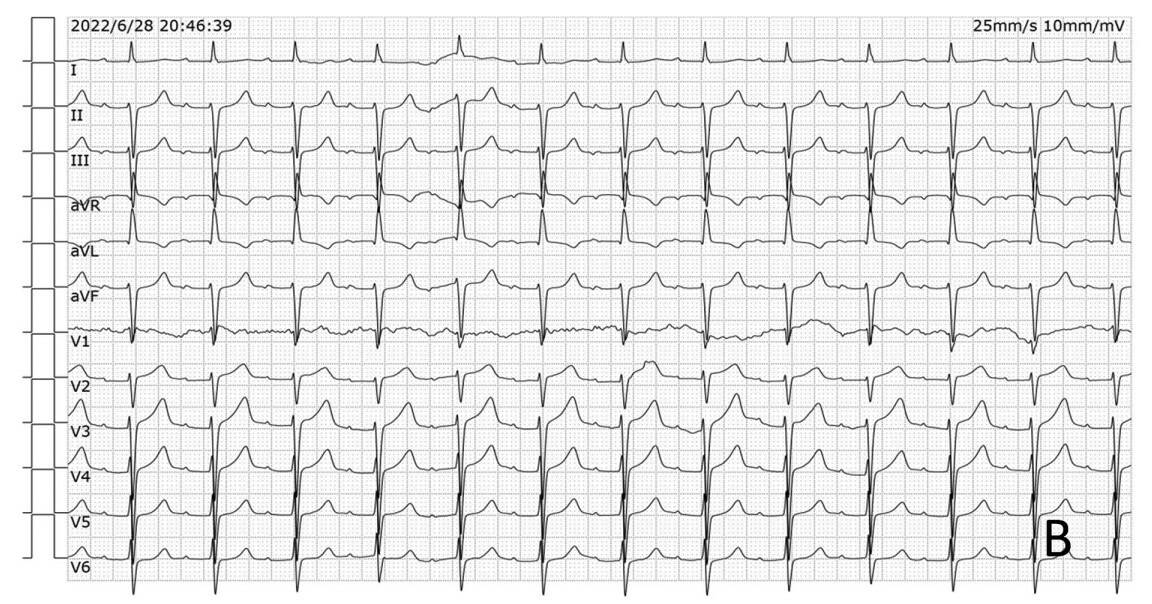 Cisto Broncogênico Cardíaco: aspectos ecocardiográficos - Blog Ecope