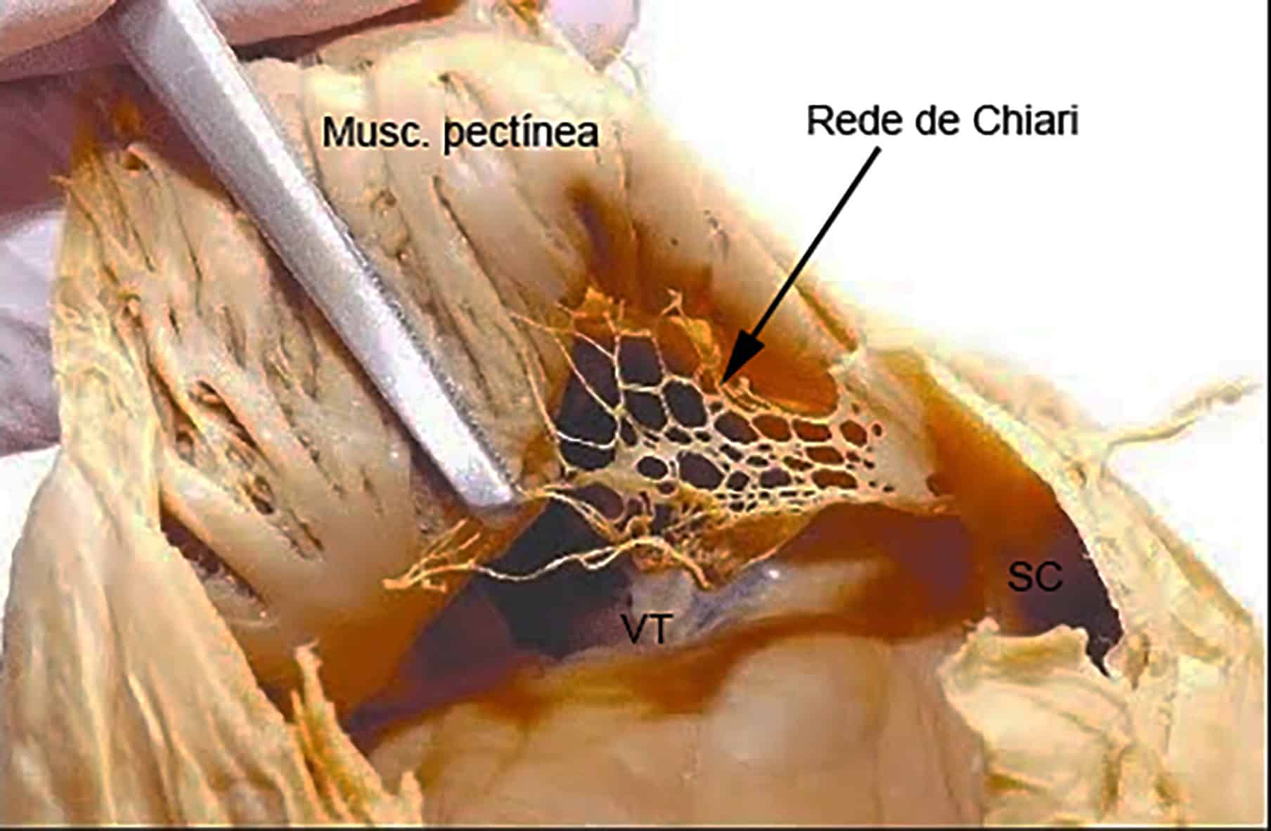 ESTRUTURAS ANATÔMICAS DO ÁTRIO DIREITO QUE FREQUENTEMENTE GERAM DÚVIDAS ...