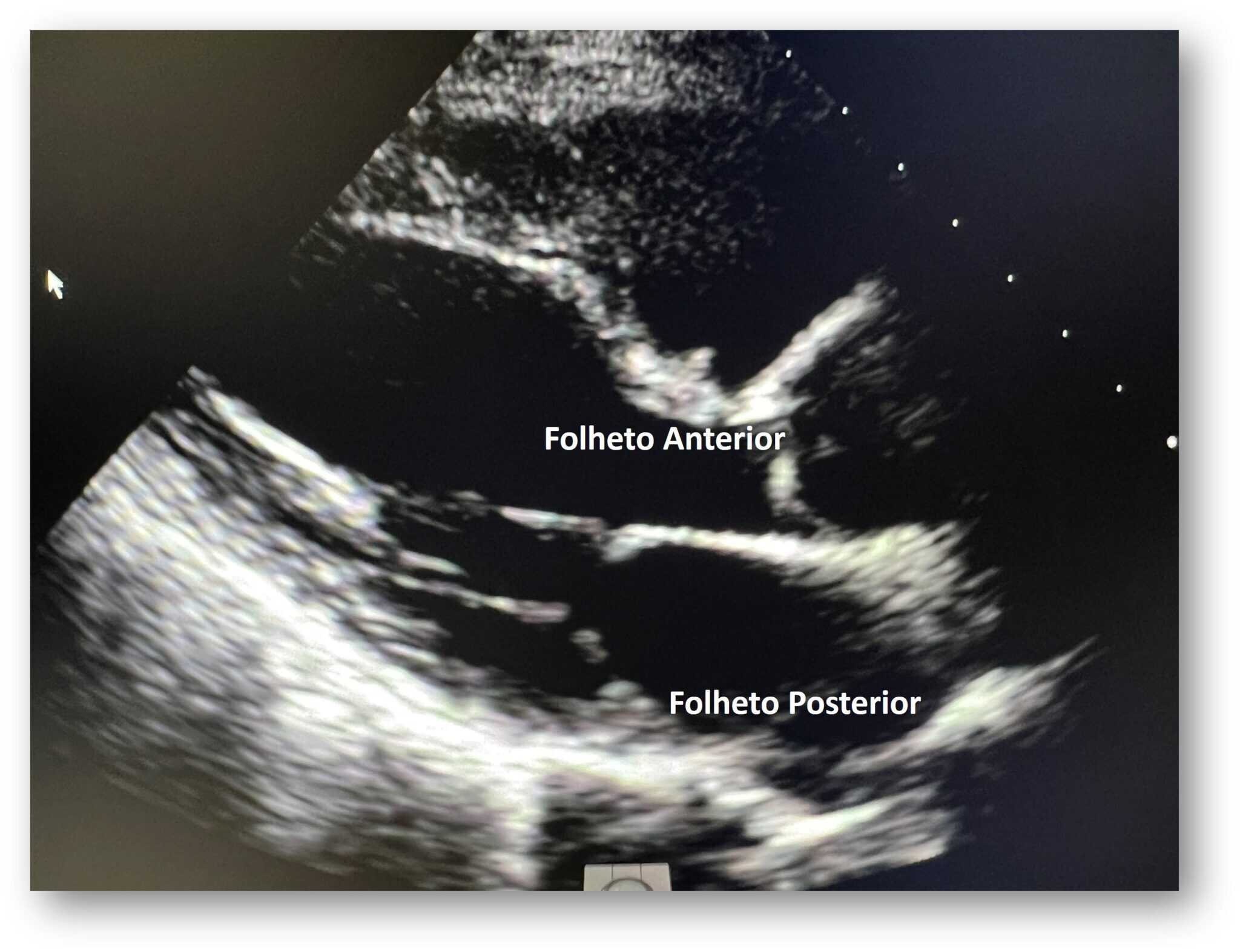 Anatomia da Valva Mitral: porque o básico é sempre encantador - Blog Ecope