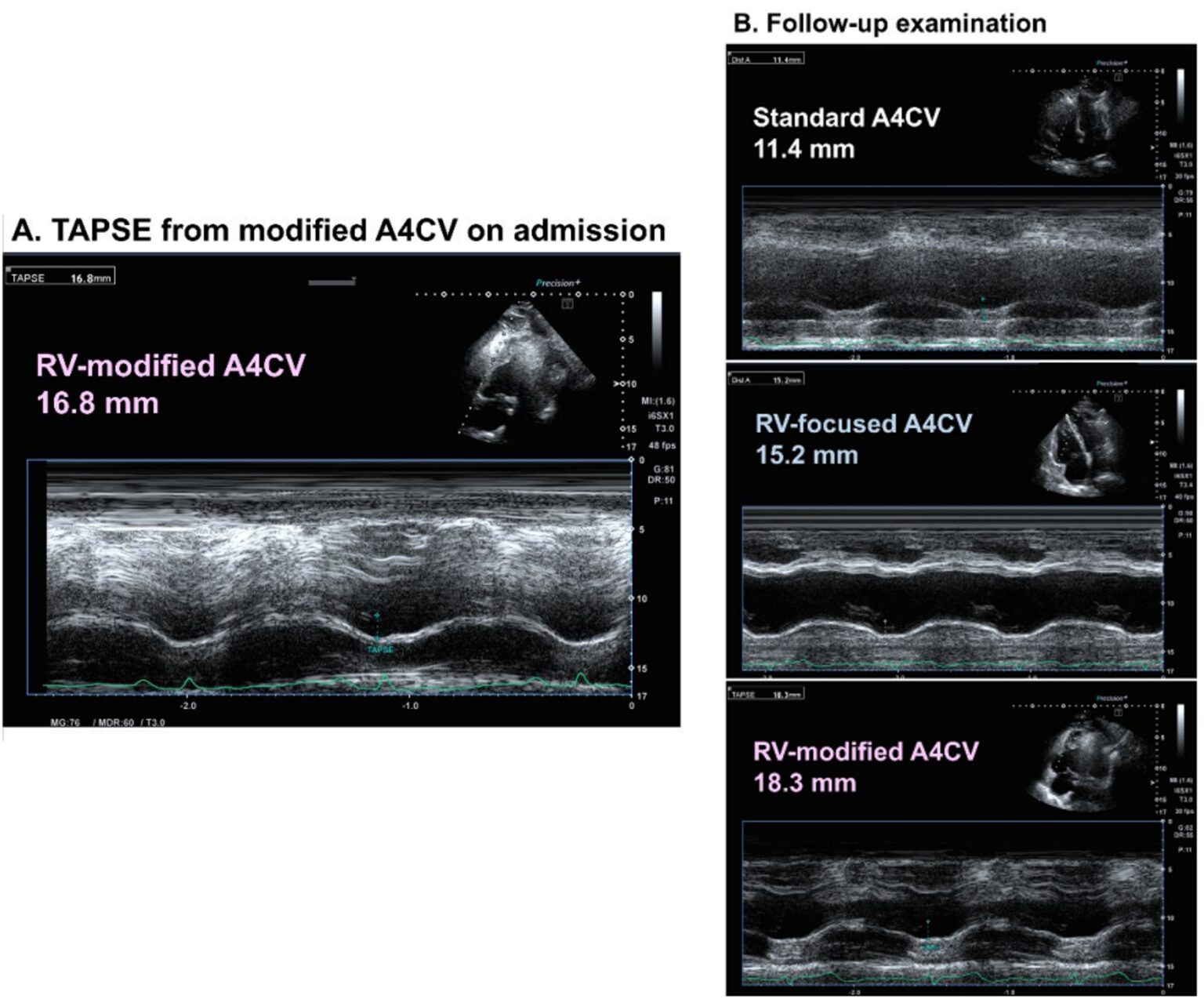 Tricuspid Annular Plane Systolic Excursion (TAPSE): como você tem feito ...