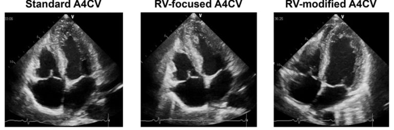 Tricuspid Annular Plane Systolic Excursion (TAPSE): como você tem feito ...