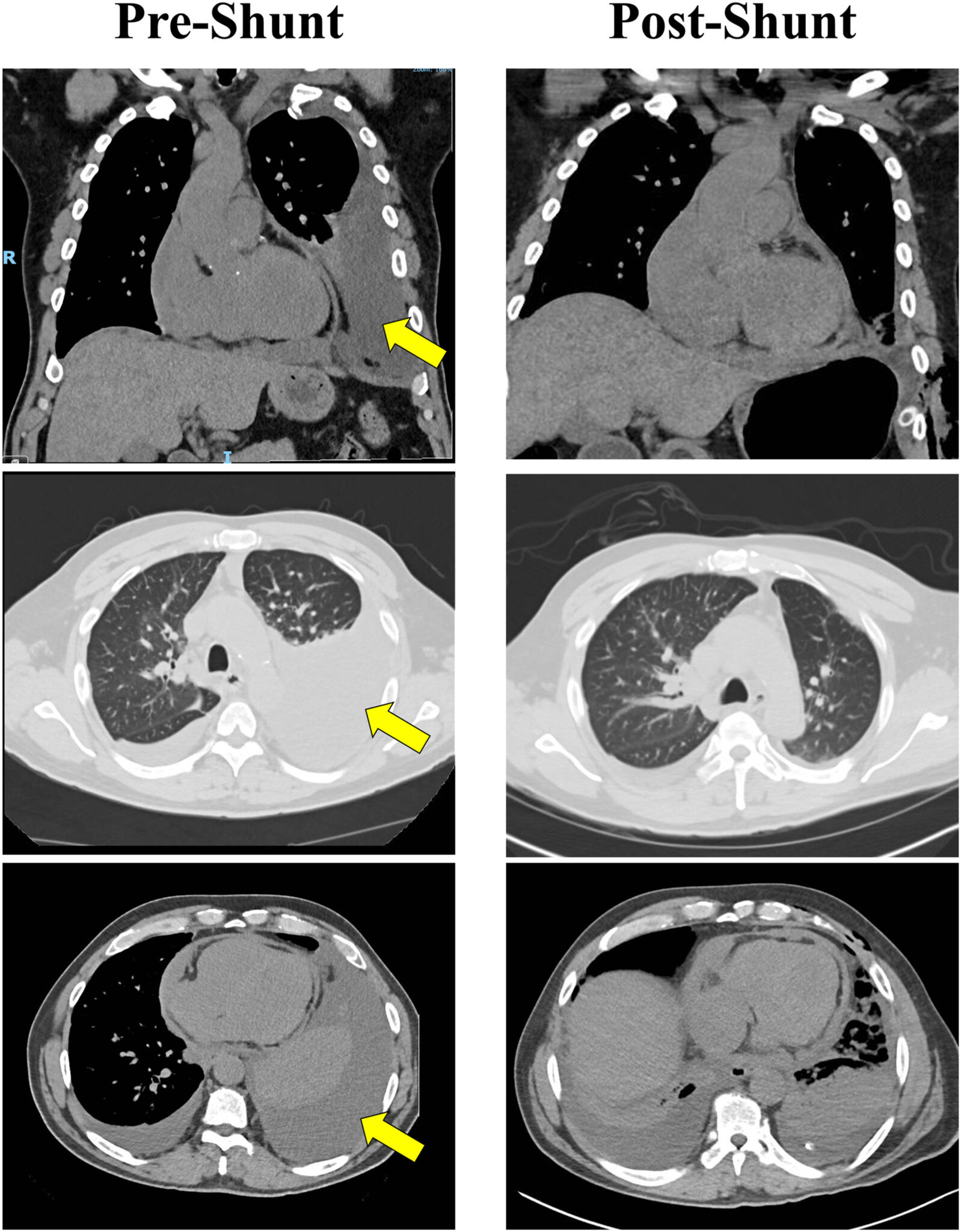 Tamponamento Cardíaco: o ventrículo esquerdo também pode colapsar ...